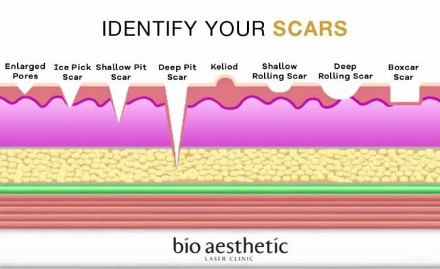 Fractional CO2 Laser Treatment Guide | Acne Scar Treatment