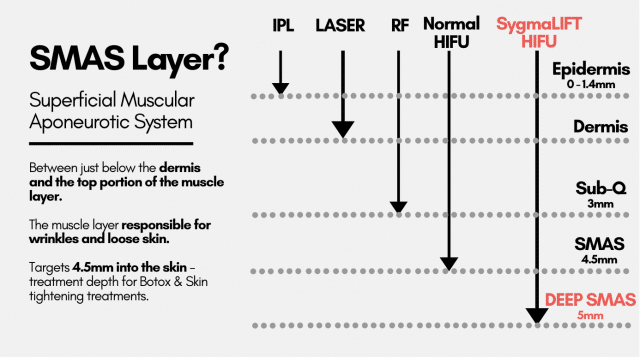 Sygmalift HIFU - Painless HIFU Price & Review - Bio Aesthetic