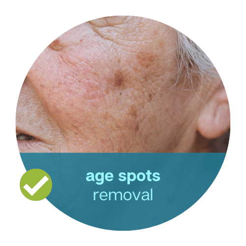 Mole Removal Singapore: Benefits, Price, Risks & Aftercare (2025 Price)