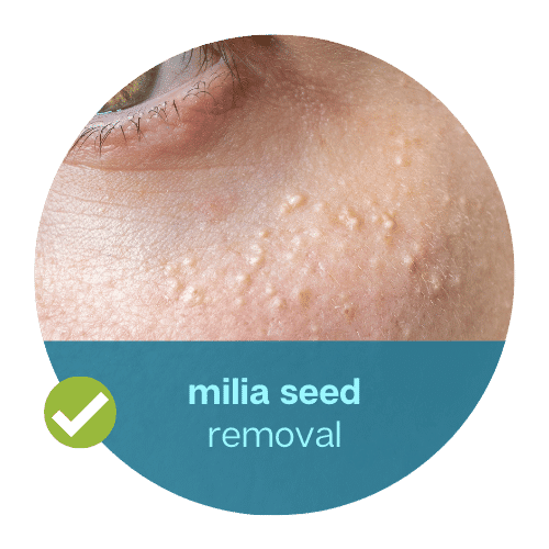 Fractional CO2 Laser Treatment Guide | Acne Scar Treatment