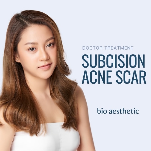 Subcision for Acne Scars - Price & Review (2025) - Bio Aesthetic