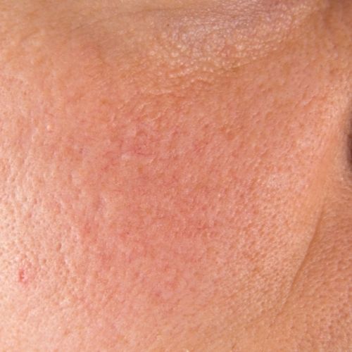 Acne Scar Removal : Treatment Options, Price and Reviews