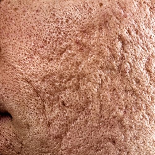 Acne Scar Removal : Treatment Options, Price and Reviews