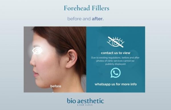 Forehead Filler: Price, Review & Side Effects (2026) - Bio Aesthetic