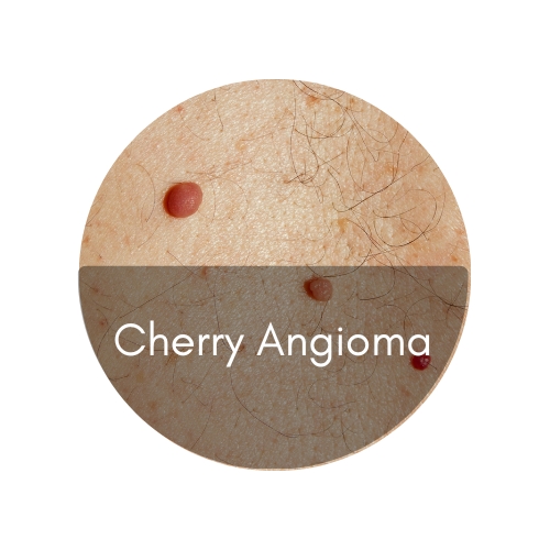 Skin Tag Removal: Price & Review Guide (2025)