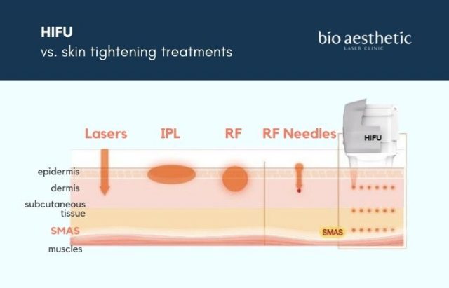 HIFU Treatment Pros and Cons - Melt Facial Fats - Bio Aesthetic