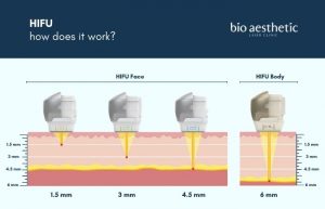 HIFU Treatment Pros and Cons - Melt Facial Fats - Bio Aesthetic