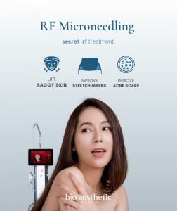 Microneedling - Secret RF - Price & Review - Bio Aesthetic Clinic