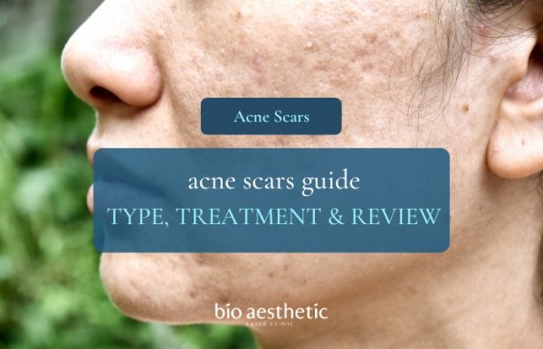 Acne Scars: Types, Causes & Evidence‑Based Treatments (Guide)