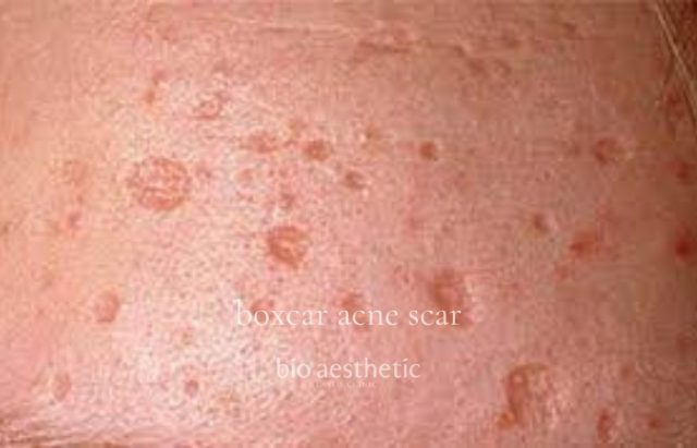 Explore the Various Types of Acne Scars: Identify and Treatment - Bio ...