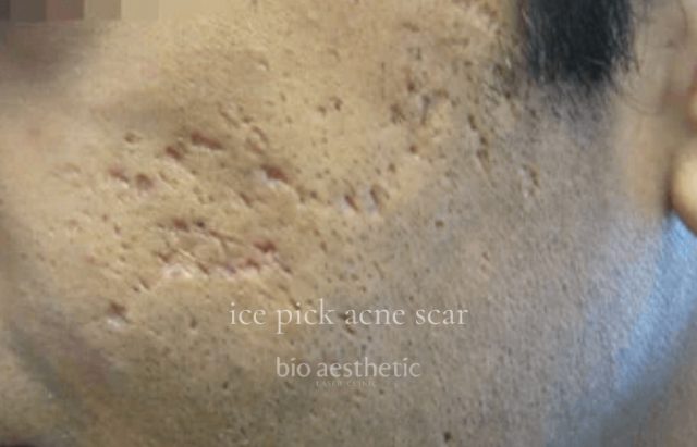 Explore the Various Types of Acne Scars: Identify and Treatment - Bio ...