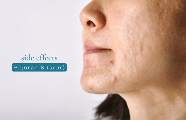 Rejuran S Acne Scar: Benefits, Price and Side Effects (2024)