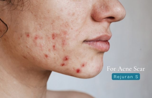 Rejuran S Acne Scar: Benefits, Price and Side Effects (2024)