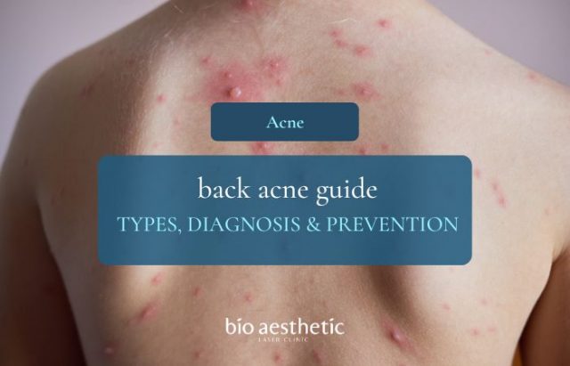Back Acne: Causes, Treatment, Prevention and Symptoms