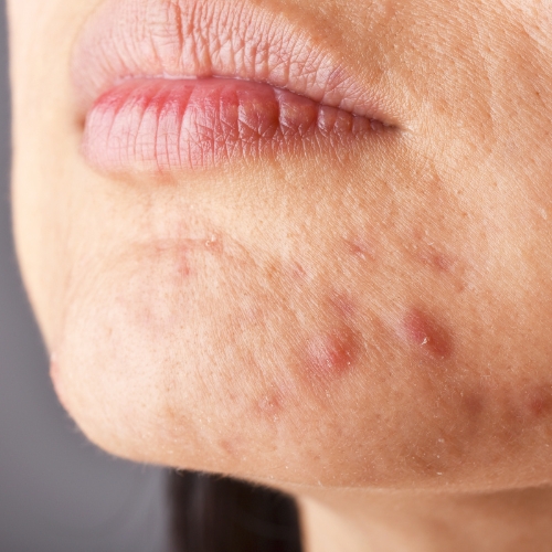 Acne: Treatment, Types, Diagnosis and Prevention