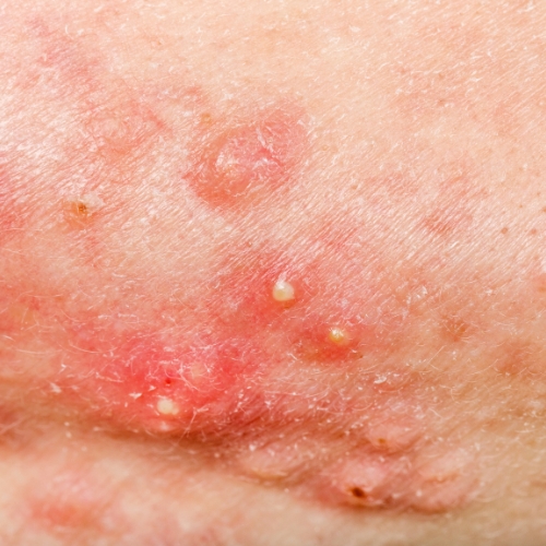 Acne: Treatment, Types, Diagnosis and Prevention