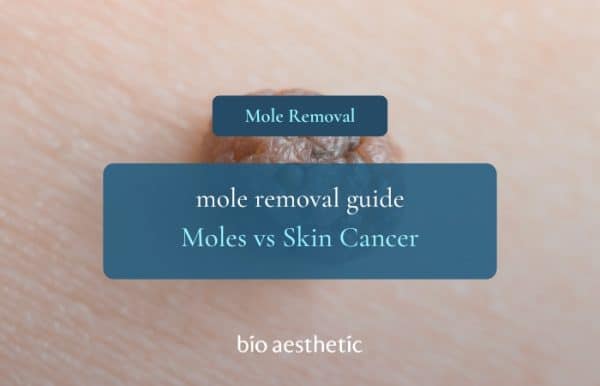 How to Spot Dangerous Moles: ABCDE Guide for Skin Cancer