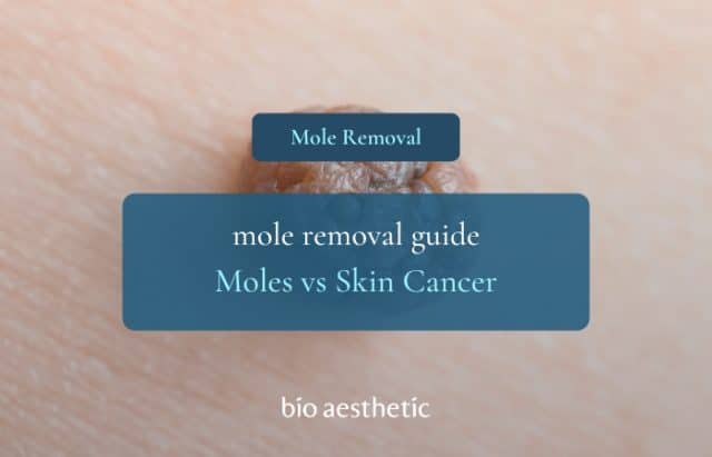 How to Spot Dangerous Moles: ABCDE Guide for Skin Cancer