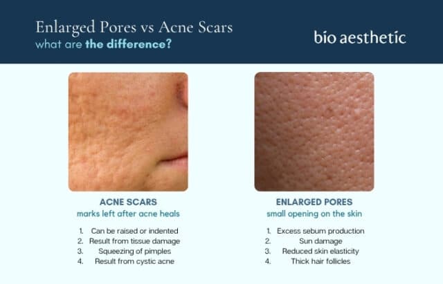 Enlarged Pores vs True Acne Scars: How to Tell (and What to Do) - Bio ...