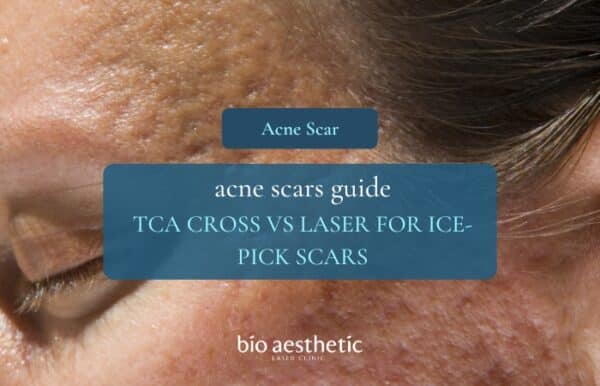 TCA CROSS vs Laser for Ice Pick Scars – When Each Works (and Why)