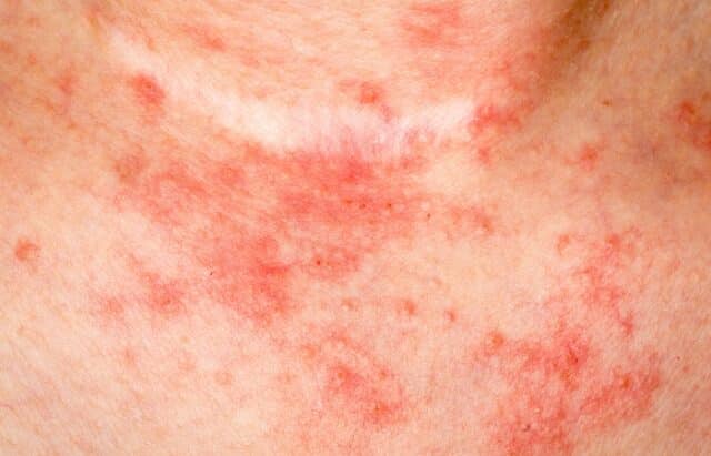 Elomet Cream (Mometasone Furoate 0.1%) Singapore — Uses, Safety, Price ...